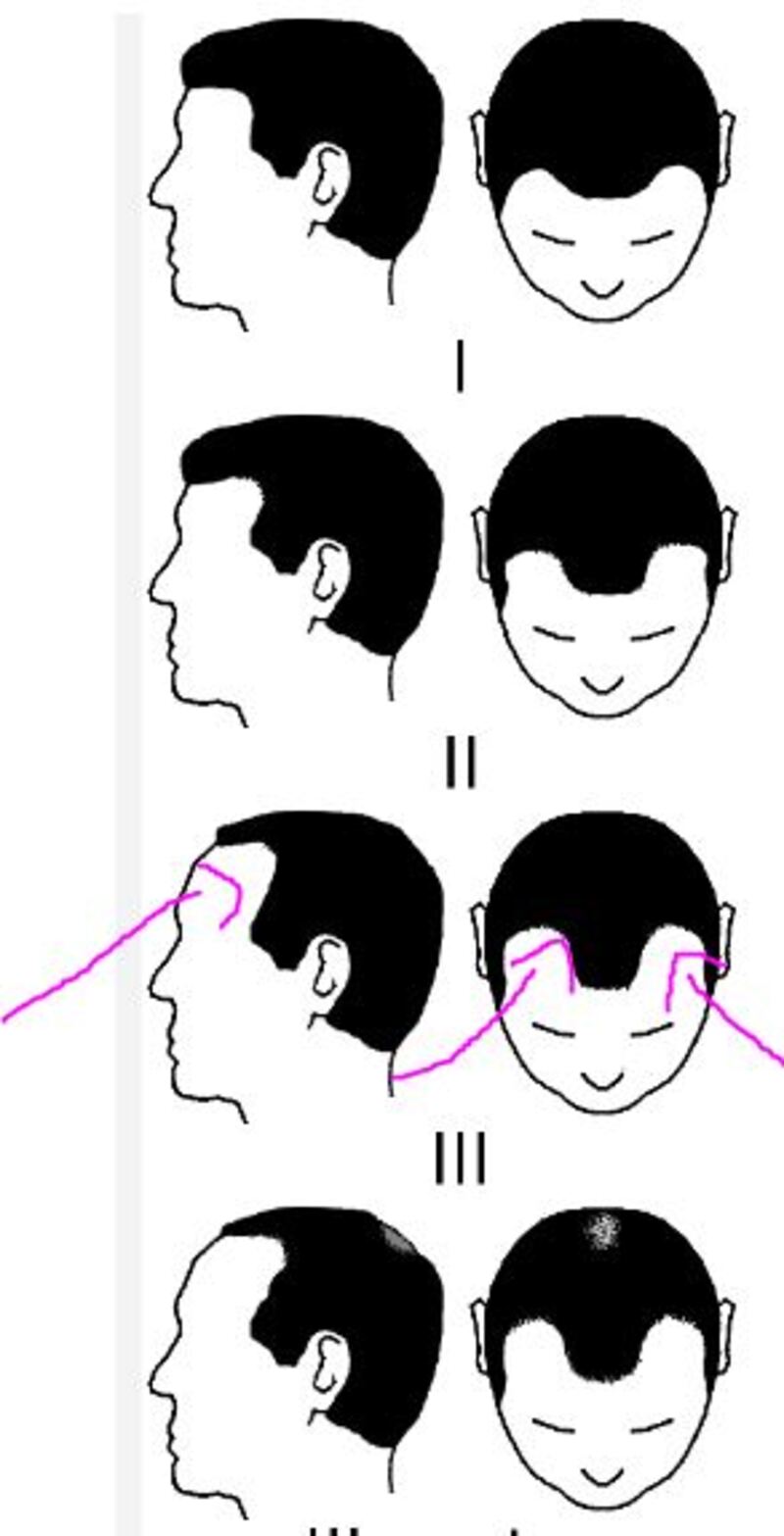 What is the meaning of "A receding hairline "? - Question about English ...