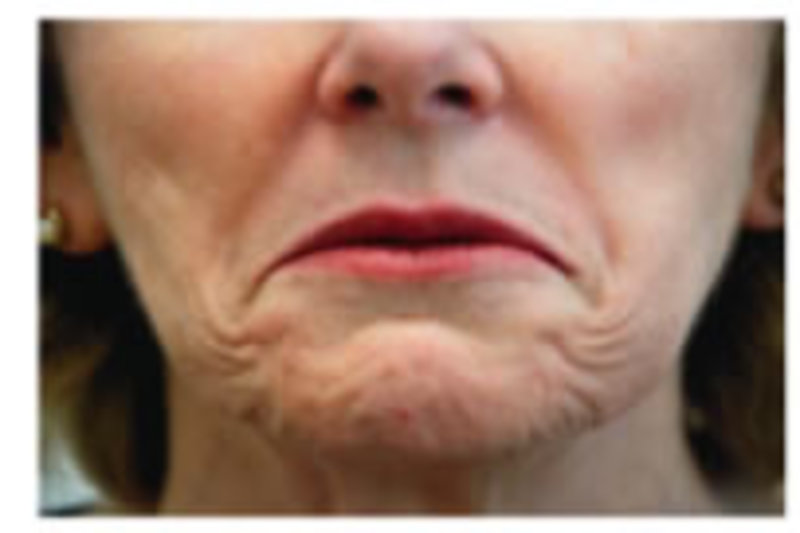 what's the difference between furrow and frown ？ like，furrow brows vs ...