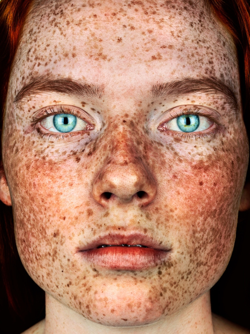 "freckle " 和 "mole" 的差別在哪裡？ | HiNative